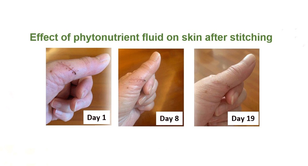 Phytonutrient-based Remedial Fluid for the Management of Hypertrophic ...